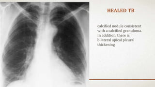 Radiographic manifestations of pulmonary tuberculosis | PPTX