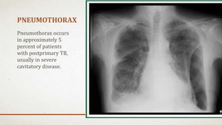 Radiographic manifestations of pulmonary tuberculosis | PPTX