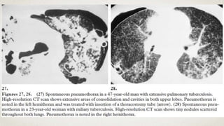 Radiographic manifestations of pulmonary tuberculosis | PPTX