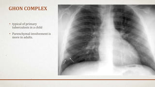 Radiographic manifestations of pulmonary tuberculosis | PPT