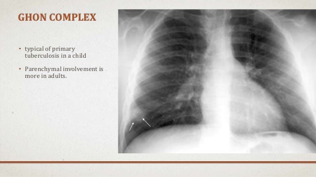 Radiographic manifestations of pulmonary tuberculosis