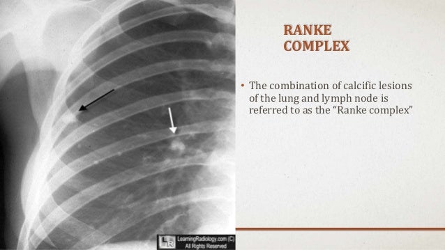 Radiographic manifestations of pulmonary tuberculosis