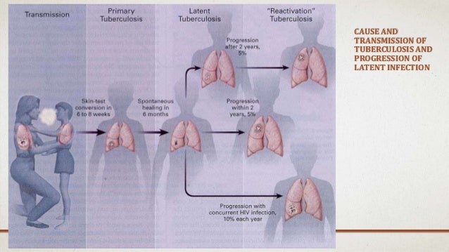 Radiographic manifestations of pulmonary tuberculosis