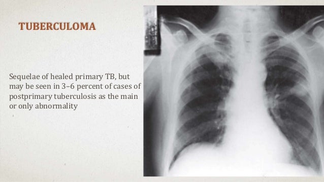 Radiographic manifestations of pulmonary tuberculosis