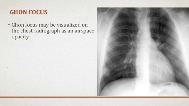 Radiographic manifestations of pulmonary tuberculosis