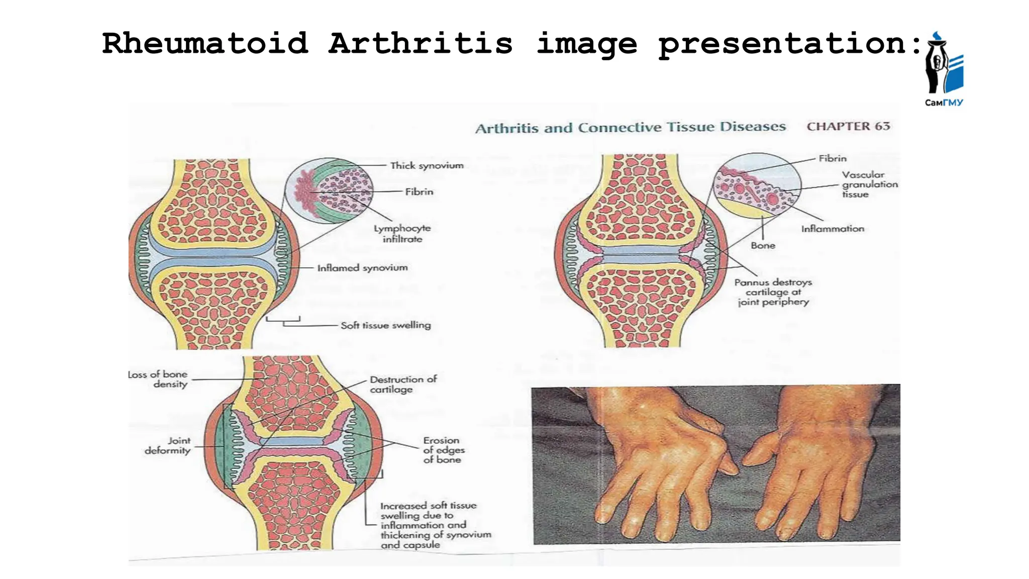 Devyani Pandya’s ppt on Rheumatoid Arthritis | PPT