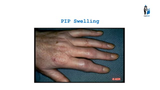 Devyani Pandya’s ppt on Rheumatoid Arthritis | PPT