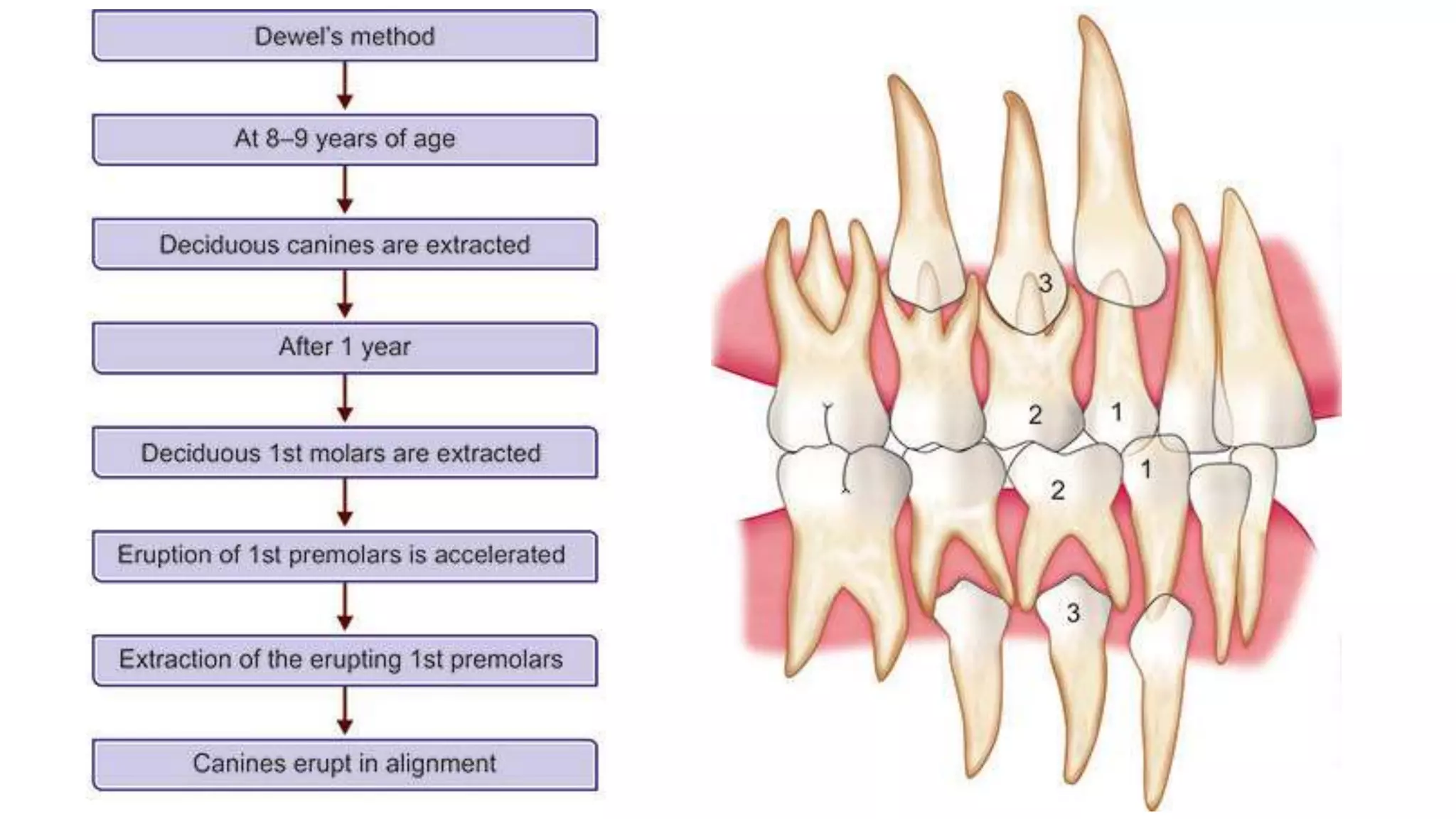 Dewel`s method of serial extraction (interceptive orthodontics).pptx
