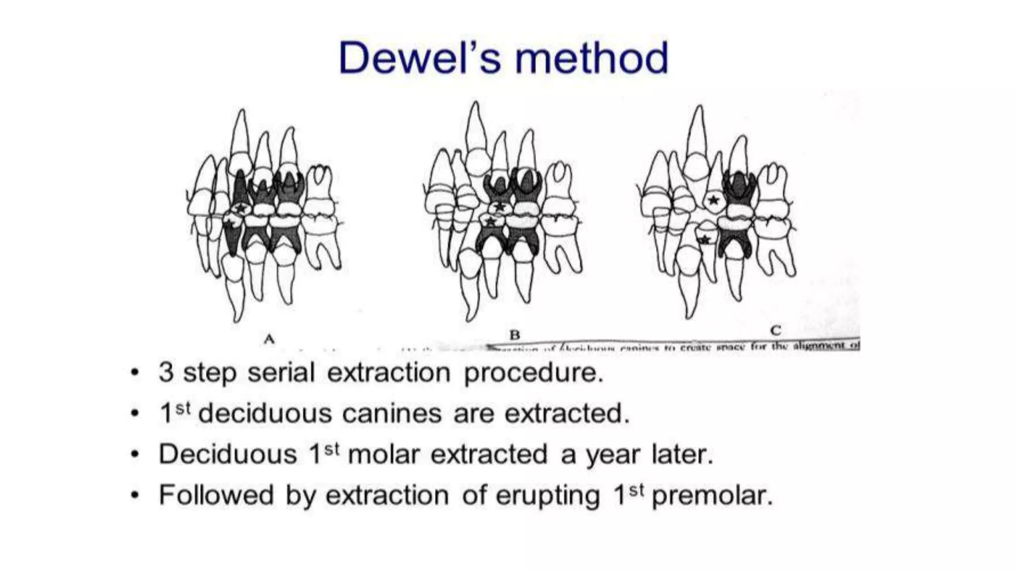 Dewel`s method of serial extraction (interceptive orthodontics).pptx