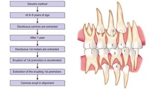 Dewel`s method of serial extraction (interceptive orthodontics).pptx