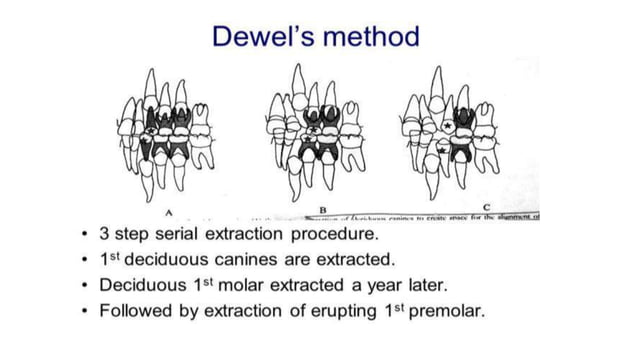 Dewel`s method of serial extraction (interceptive orthodontics).pptx
