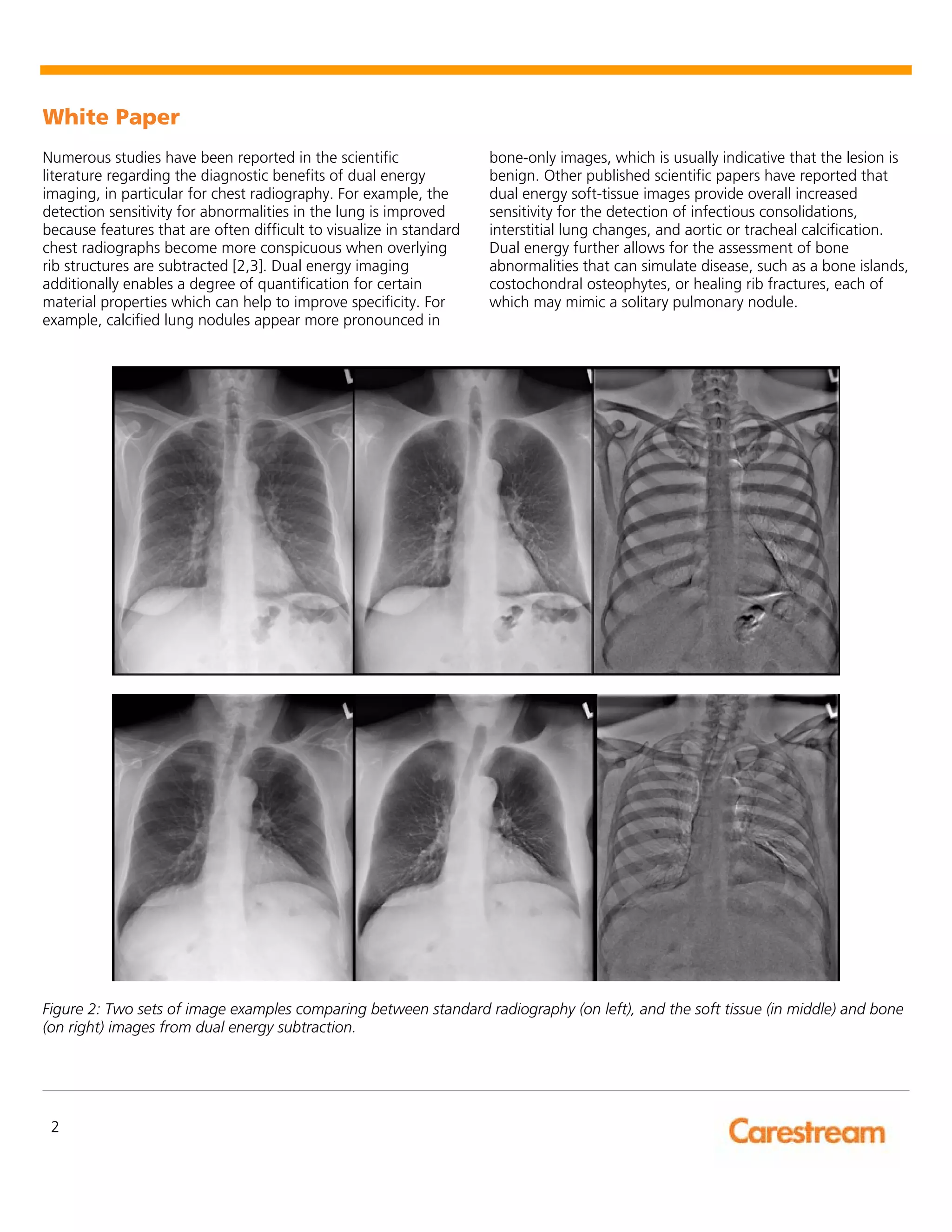 Dose Efficient Dual Energy Subtraction Radiography - Theory of ...