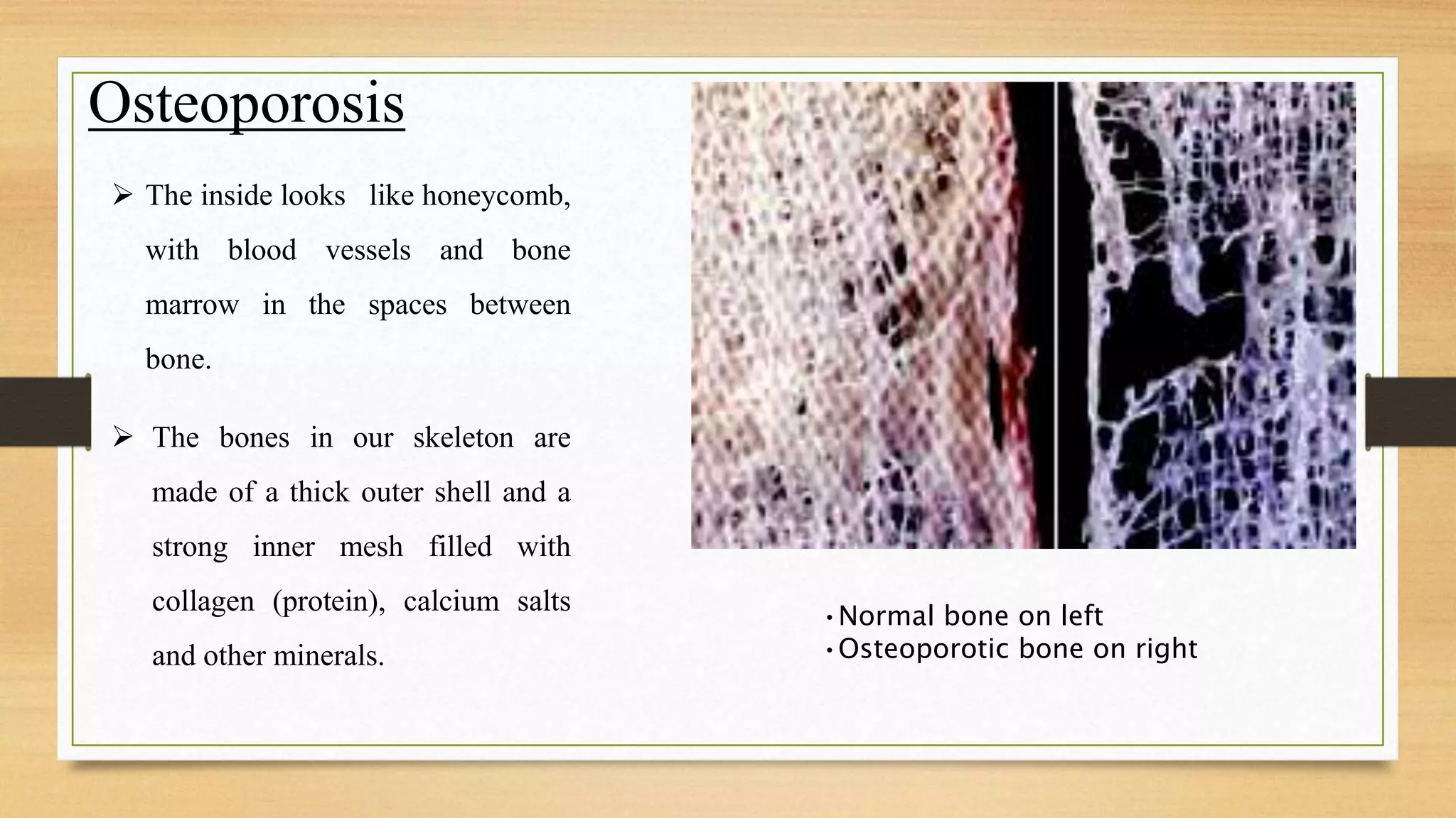 Osteoporosis and it's insrument Dexa | PPTX