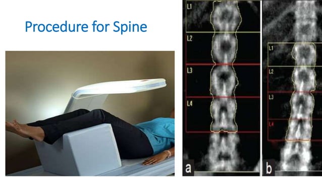 Dexa and its aplication | PPTX | Bone and Joint Conditions | Diseases ...