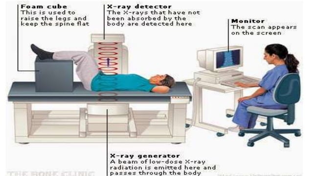 Dexa and its aplication | PPTX | Bone and Joint Conditions | Diseases ...
