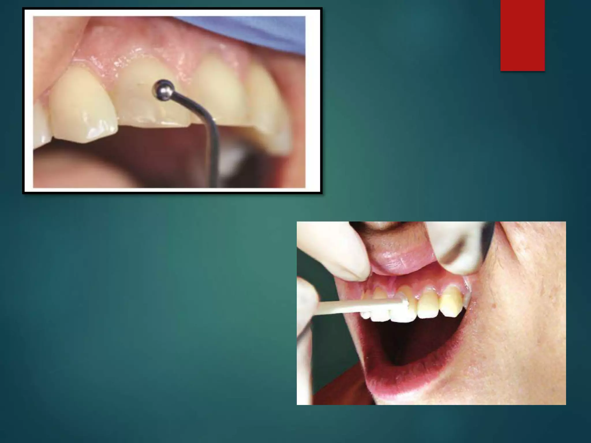 PULP VITALITY TEST.pptx