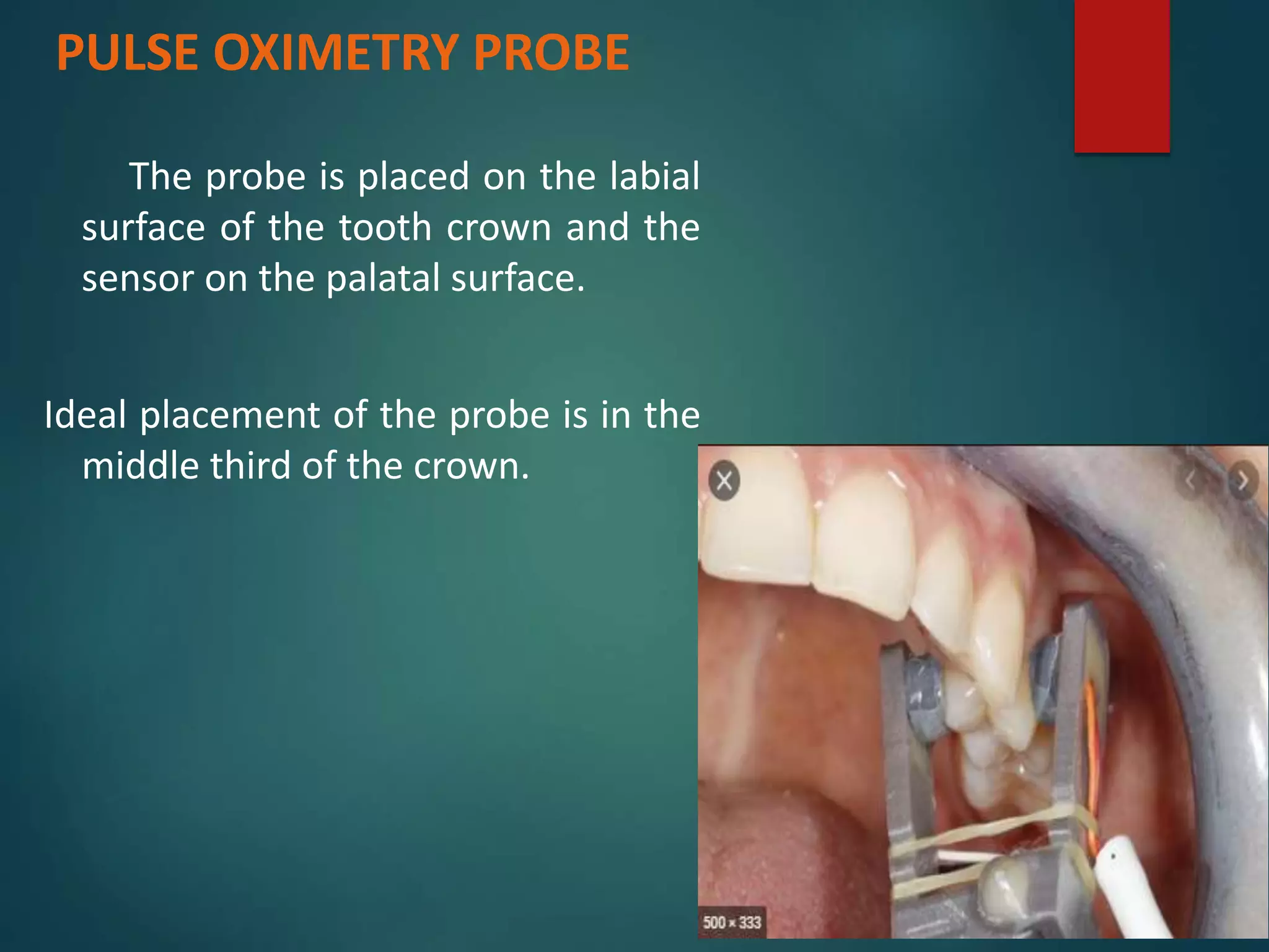 PULP VITALITY TEST.pptx
