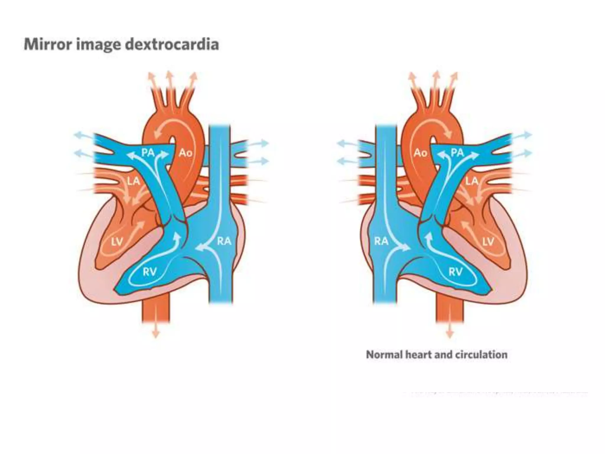 Dextrocardia By Dr. Vaibhav Yawalkar | PPTX | Heart and Cardiovascular ...