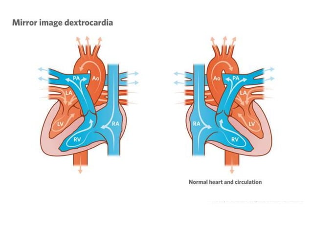Dextrocardia By Dr. Vaibhav Yawalkar | PPT