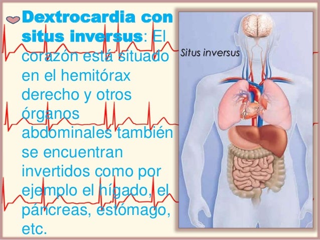 Dextrocardia