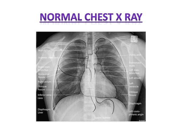 Dextro cardia a rare case | PPT