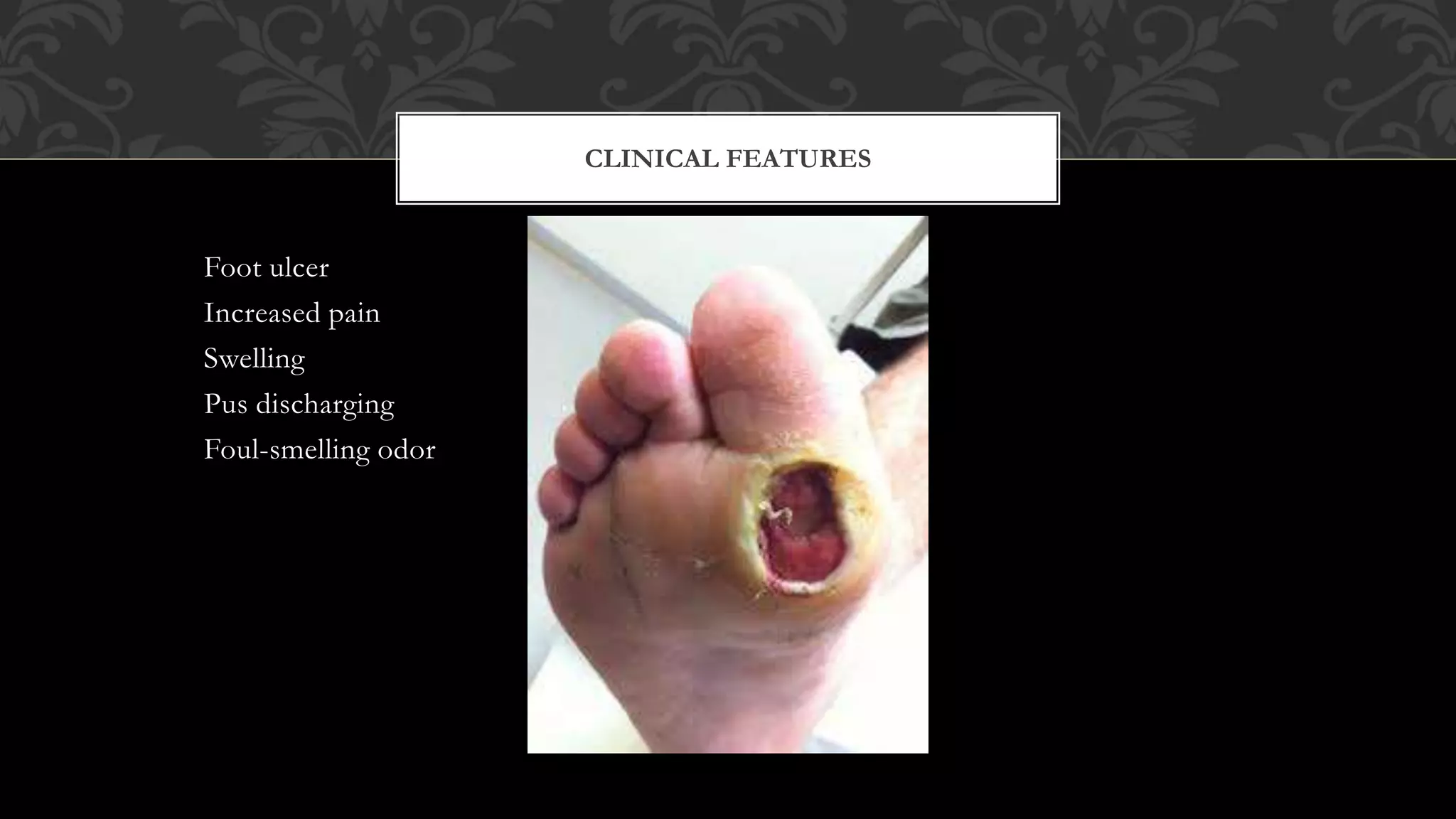 Diabetic Foot Sepsis | PPTX