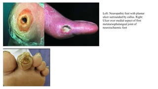 diabetic foot ulceratif -180729053052.pdf
