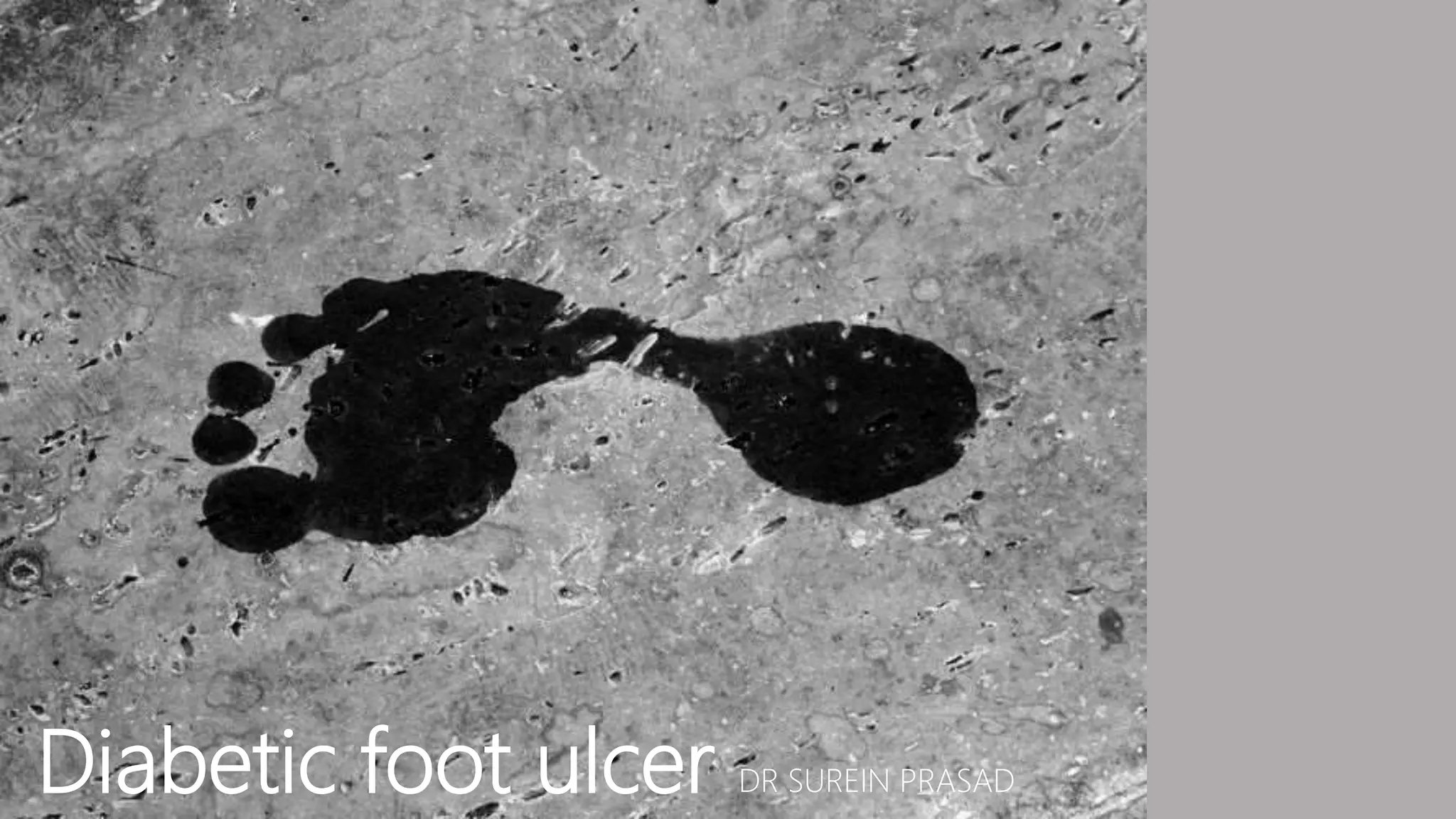 Diabetic Foot Ulcer Ppt