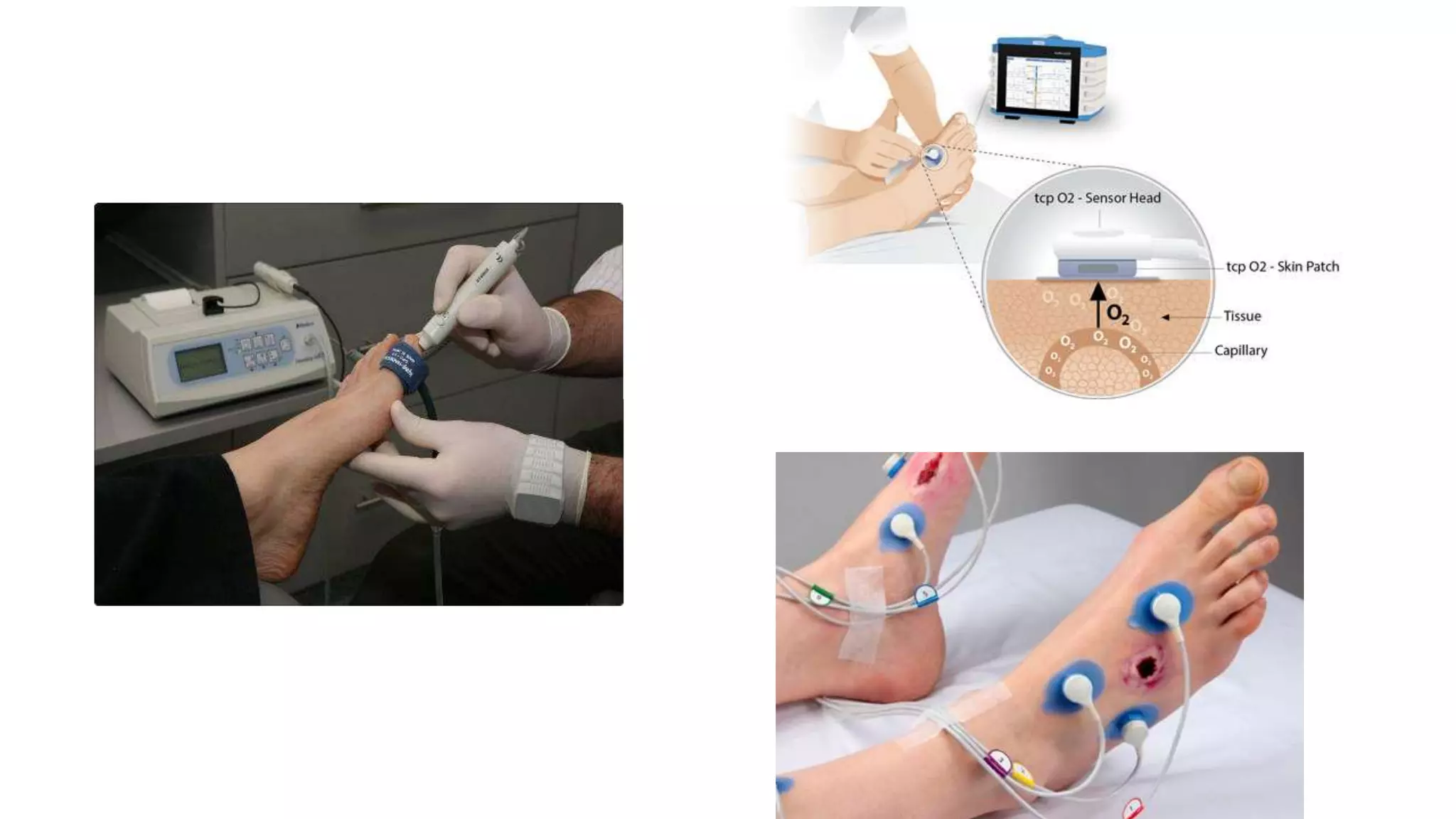 DIABETIC FOOT ULCER | PPTX