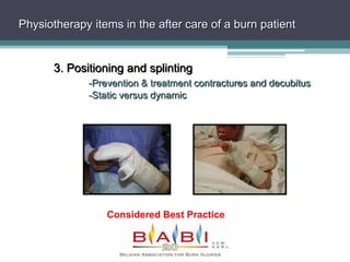 babi-20-burn-scar-and-rehabilitation-2.ppt | Physical Therapy | Wellness
