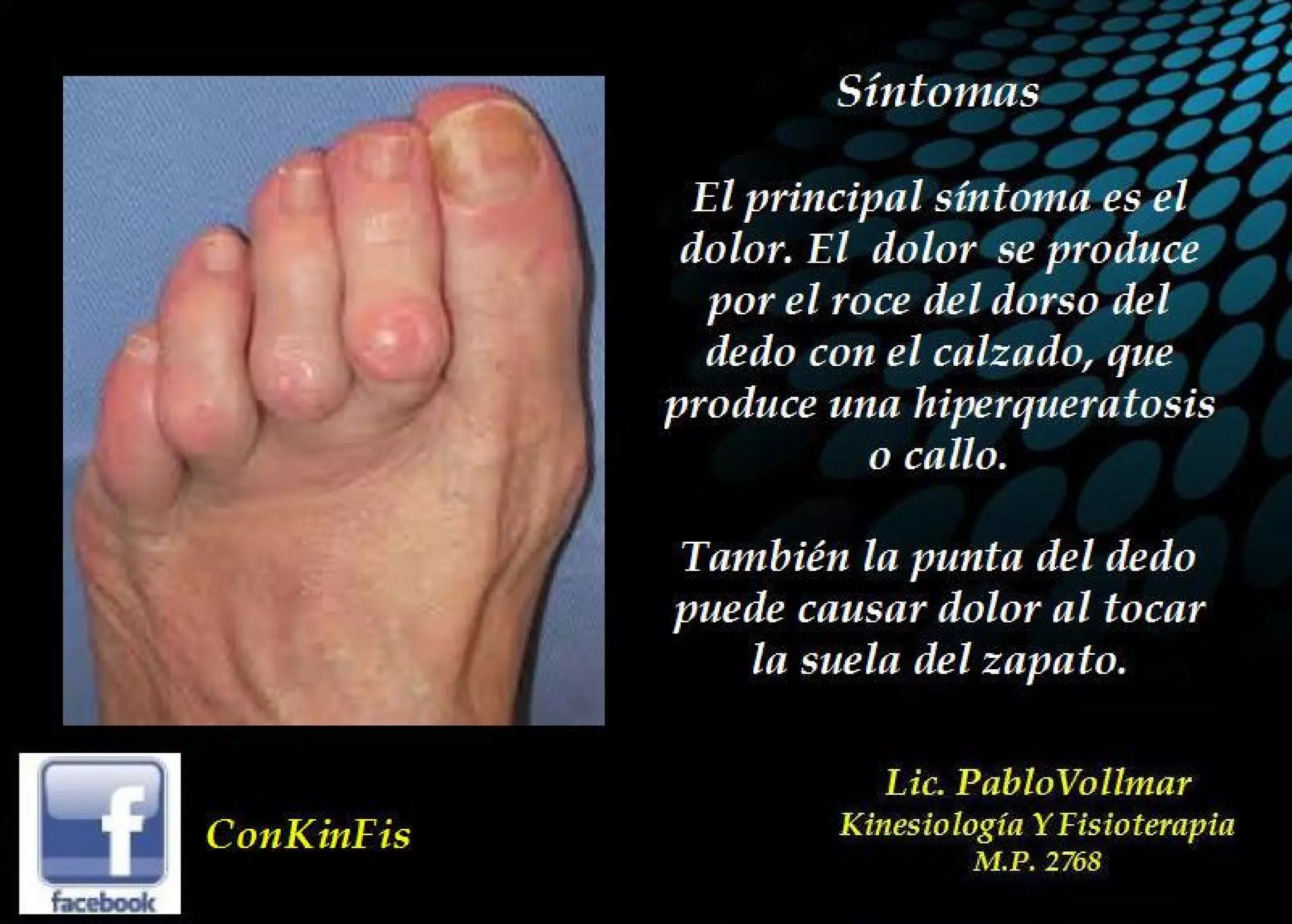 Deformaciones de los dedos del Pie | PPT