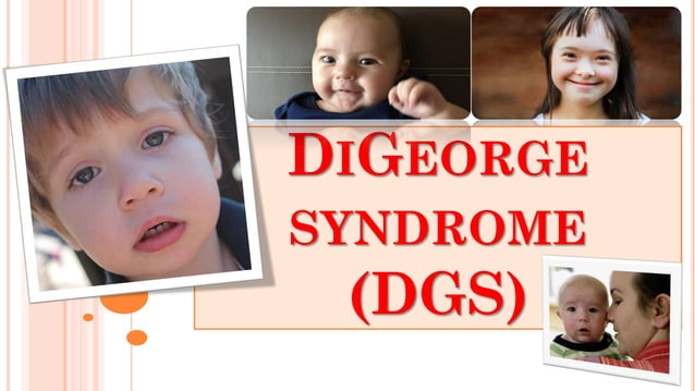DiGeorge Syndrome (DGS).pdf
