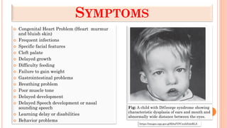 DiGeorge Syndrome (DGS).pdf