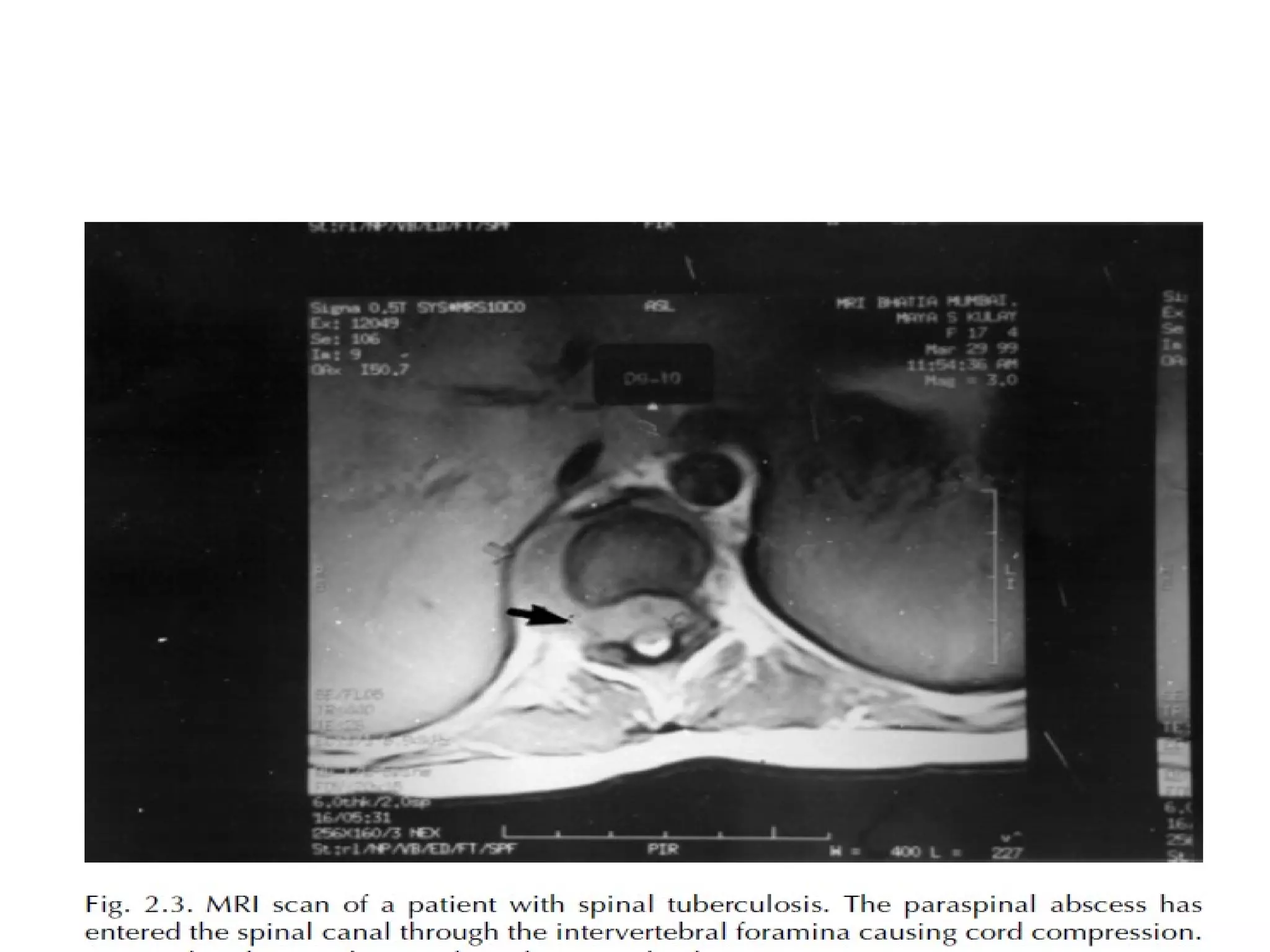 Pott's Disease | PPT
