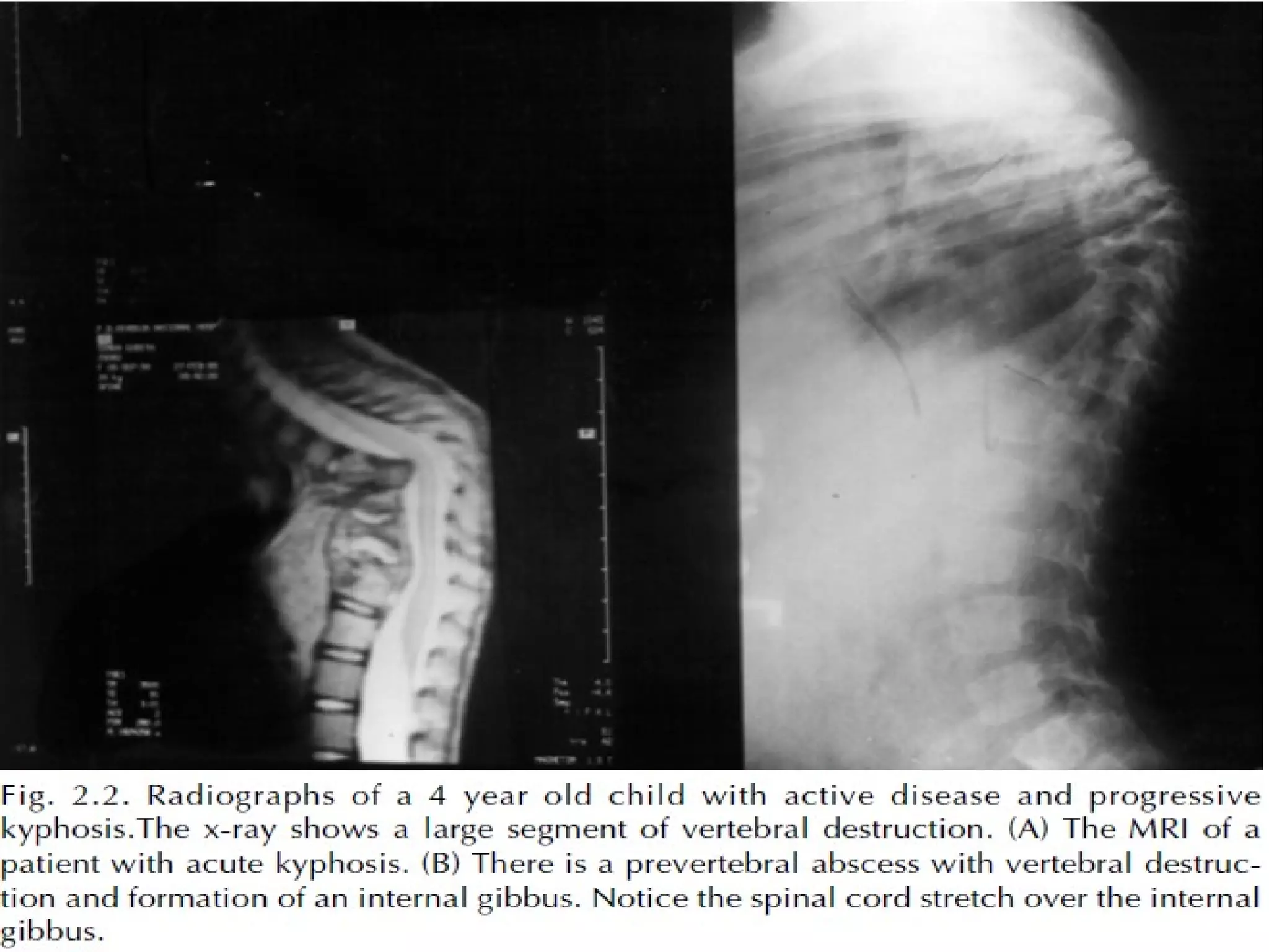 Pott's Disease | PPT