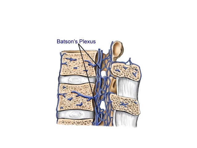 Pott's Disease | PPT | Physical Therapy | Wellness