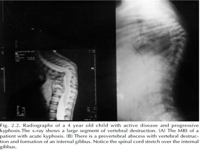 Pott's Disease | PPT | Physical Therapy | Wellness
