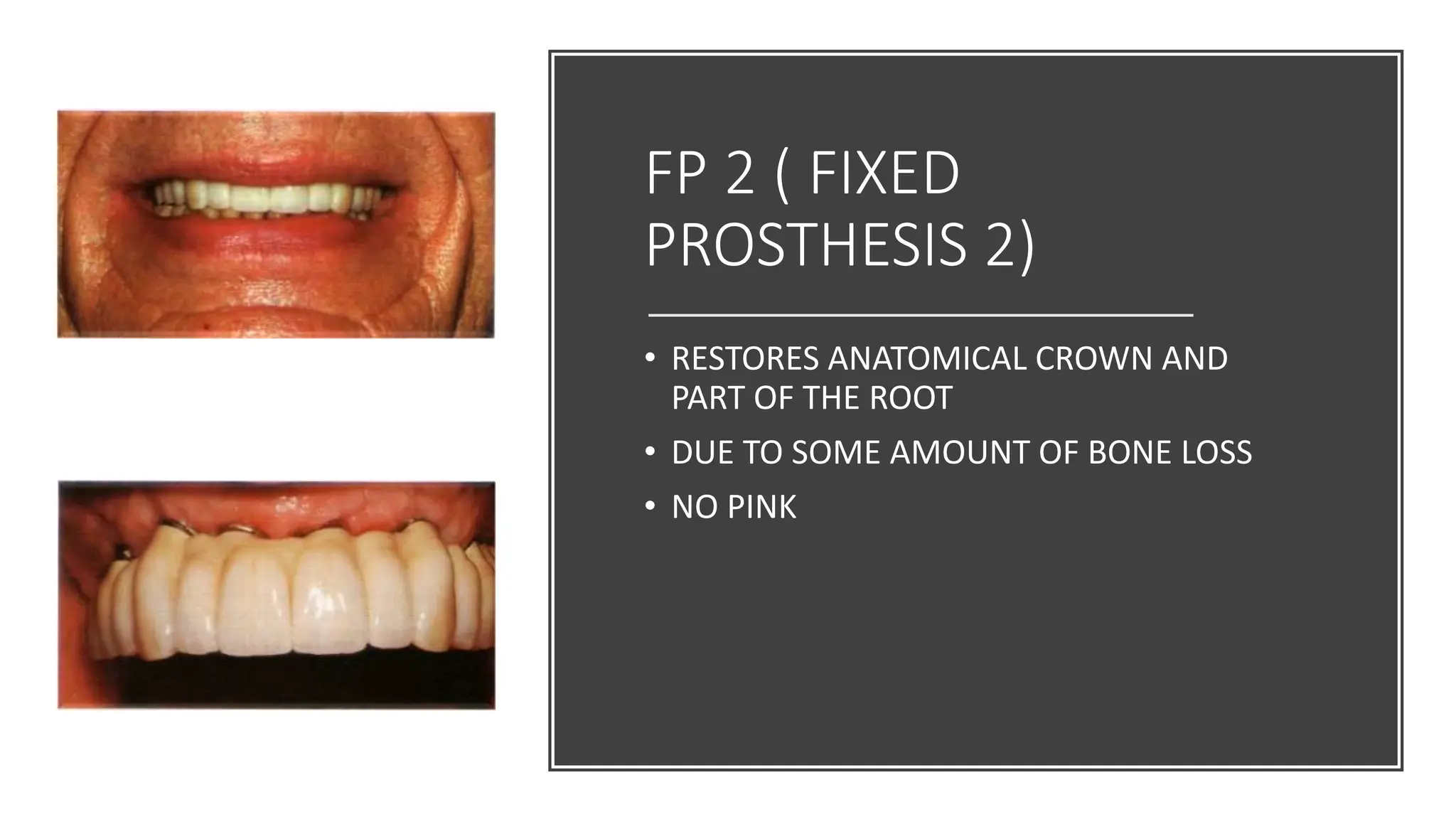 prosthetic concepts in implant dentistry | PPTX