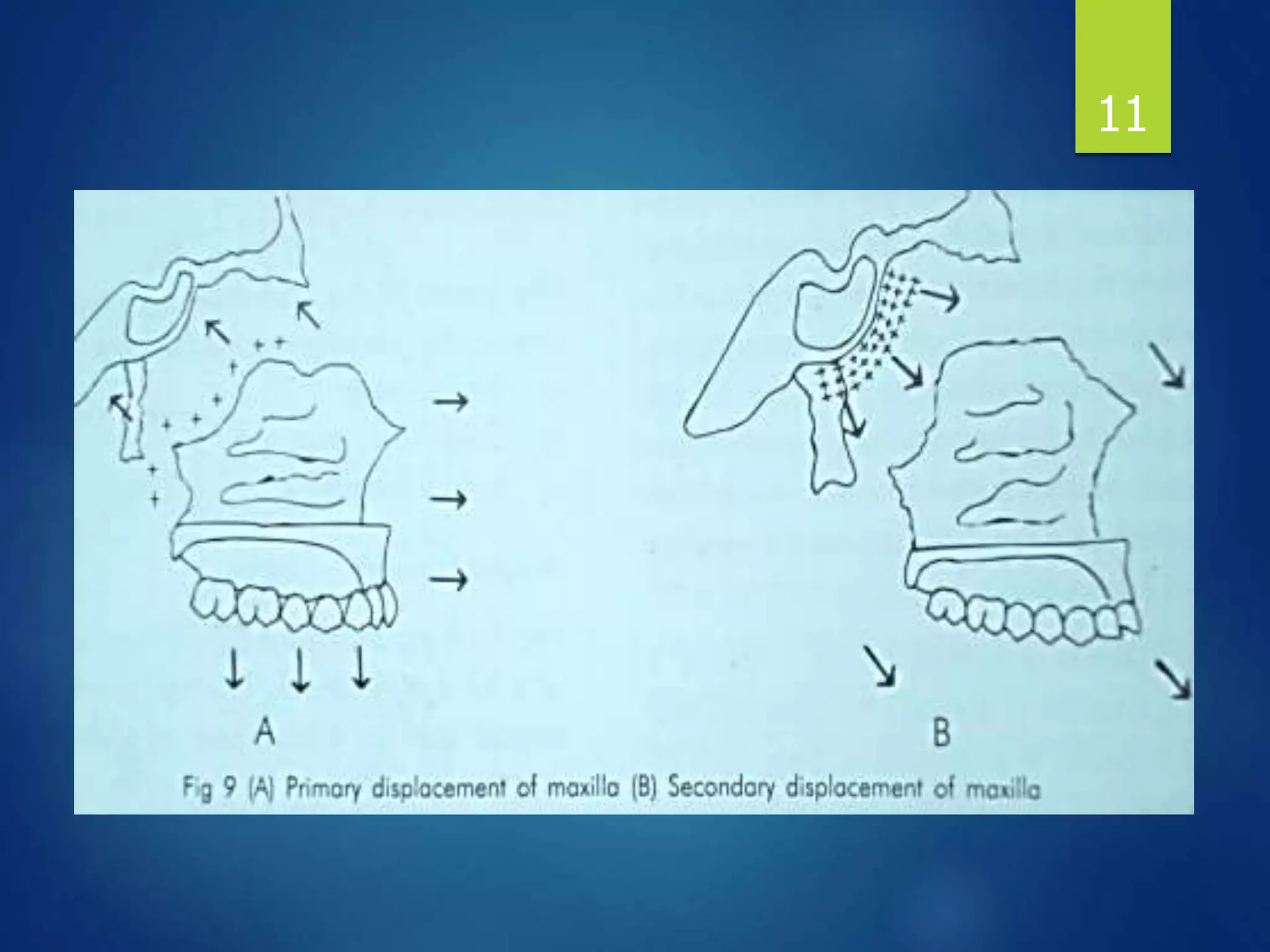 Post-natal Growth of Maxilla and Mandible | PPT