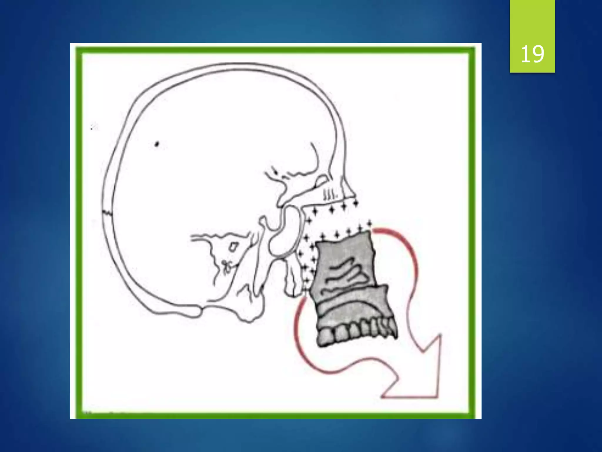 Post-natal Growth of Maxilla and Mandible | PPT