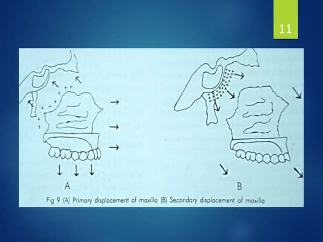 Post-natal Growth of Maxilla and Mandible | PPT | Bone and Joint Conditions | Diseases and ...