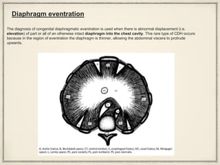 Diaphragmatic hernia in children | PPTX
