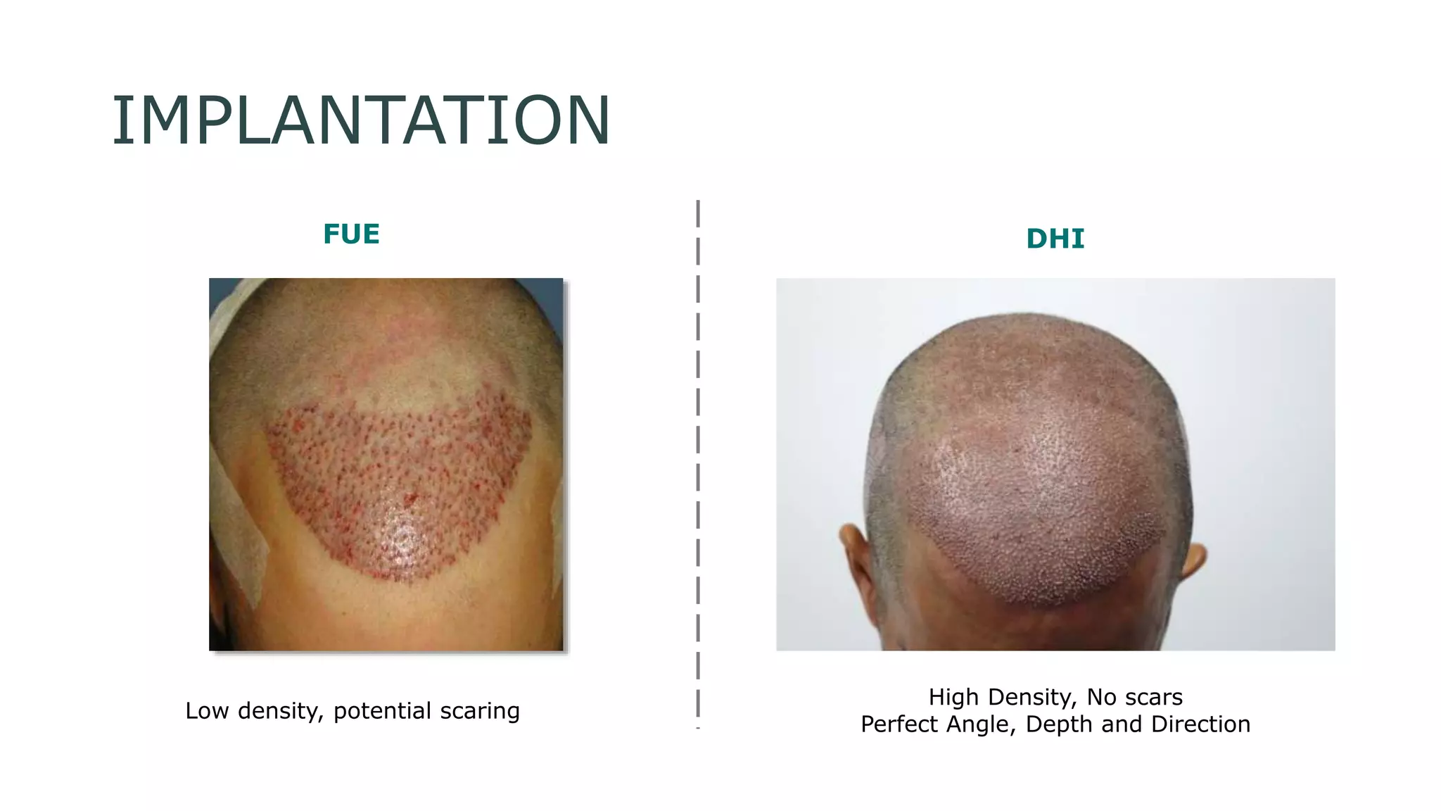 DHI Evolution of hair transplant presentation | PPTX