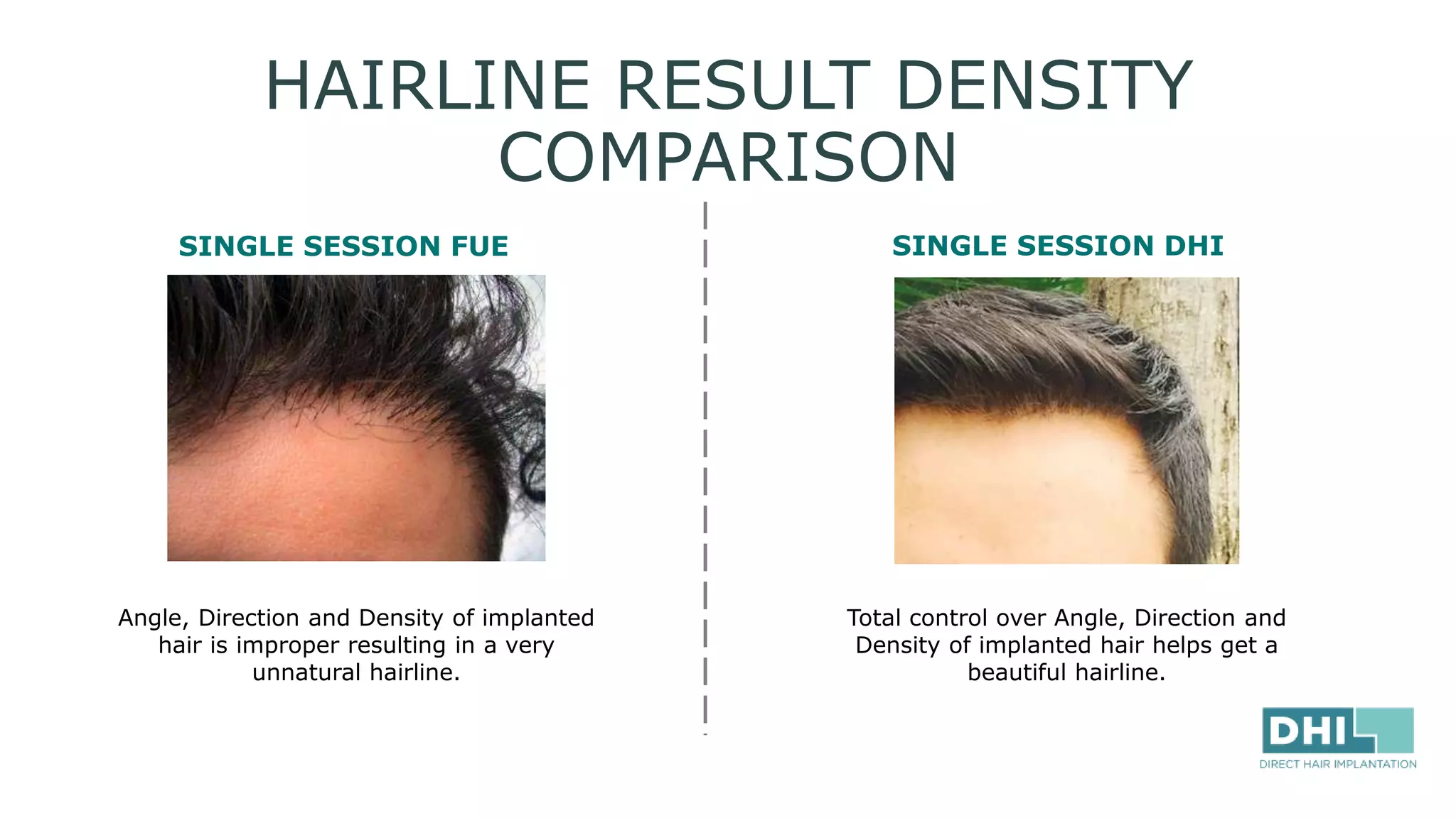 DHI Evolution of hair transplant presentation | PPTX