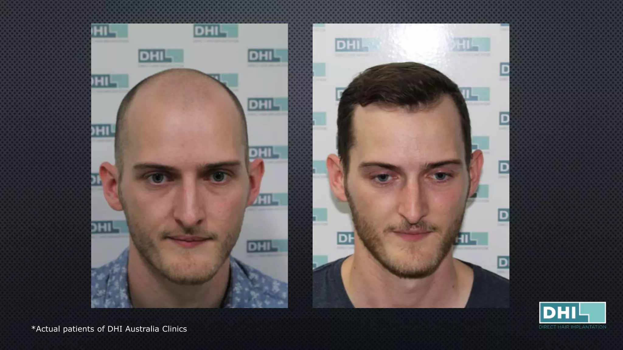 DHI Evolution of hair transplant presentation | PPTX