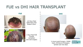 DHI Evolution of hair transplant presentation | PPTX