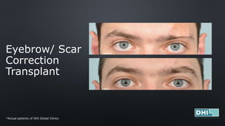 DHI Evolution of hair transplant presentation | PPTX