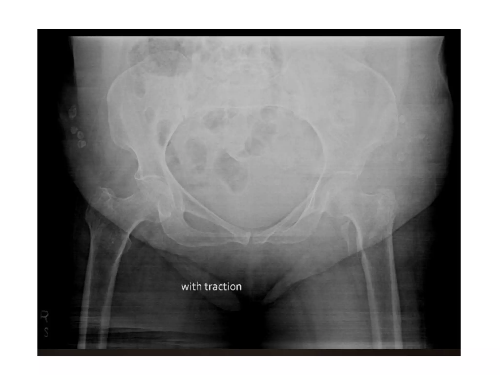 Dynamic hip screw with Trochanteric Stabilization plate Case ...