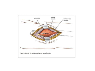 Dynamic hip screw with Trochanteric Stabilization plate Case ...
