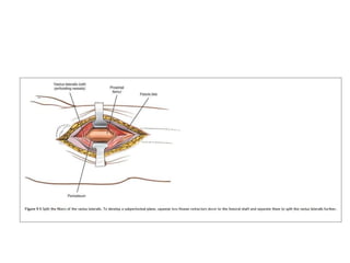Dynamic hip screw with Trochanteric Stabilization plate Case ...